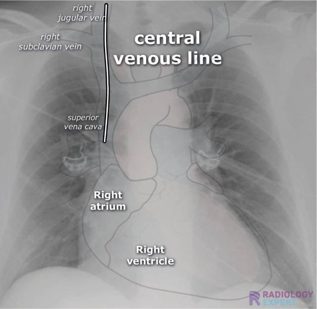 Chest X-ray ICU
