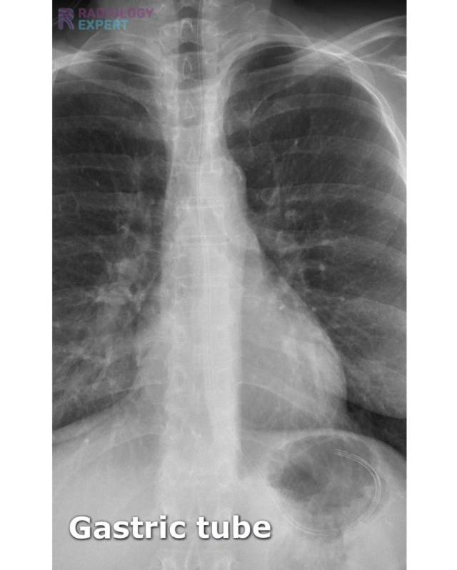 Chest X-ray ICU