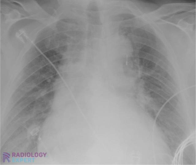 Chest X-ray ICU