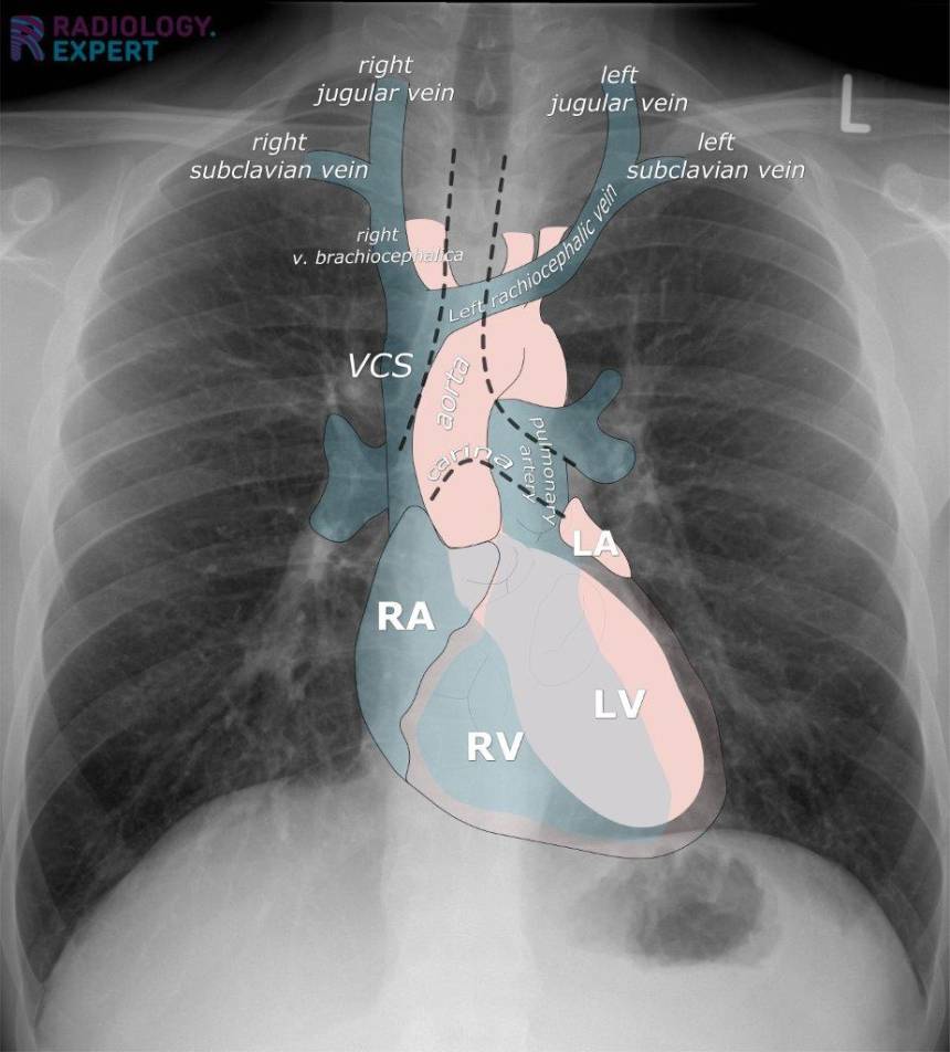 Chest X-ray ICU