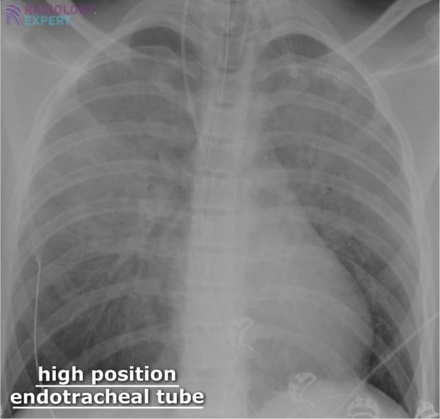 Chest X-ray ICU