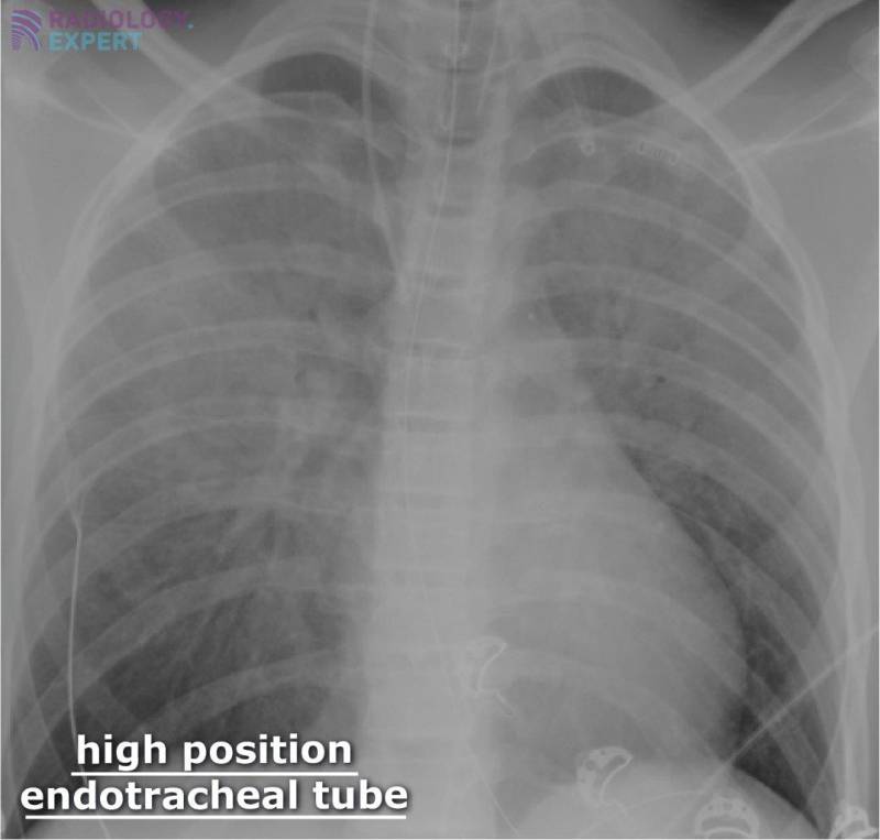 Chest X-ray ICU