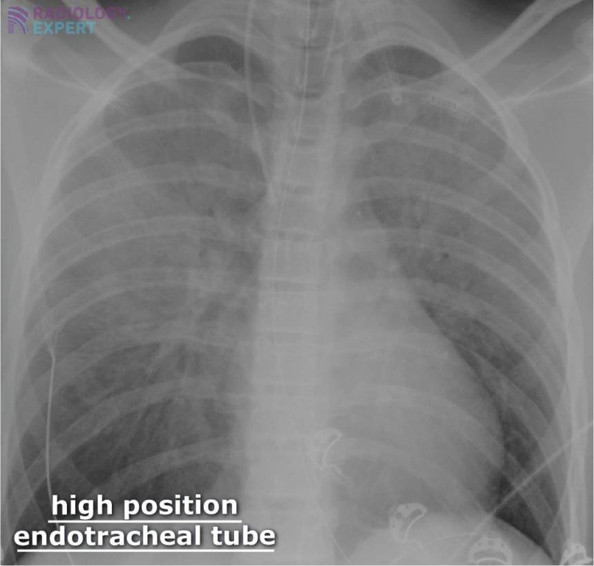 Chest X-ray ICU