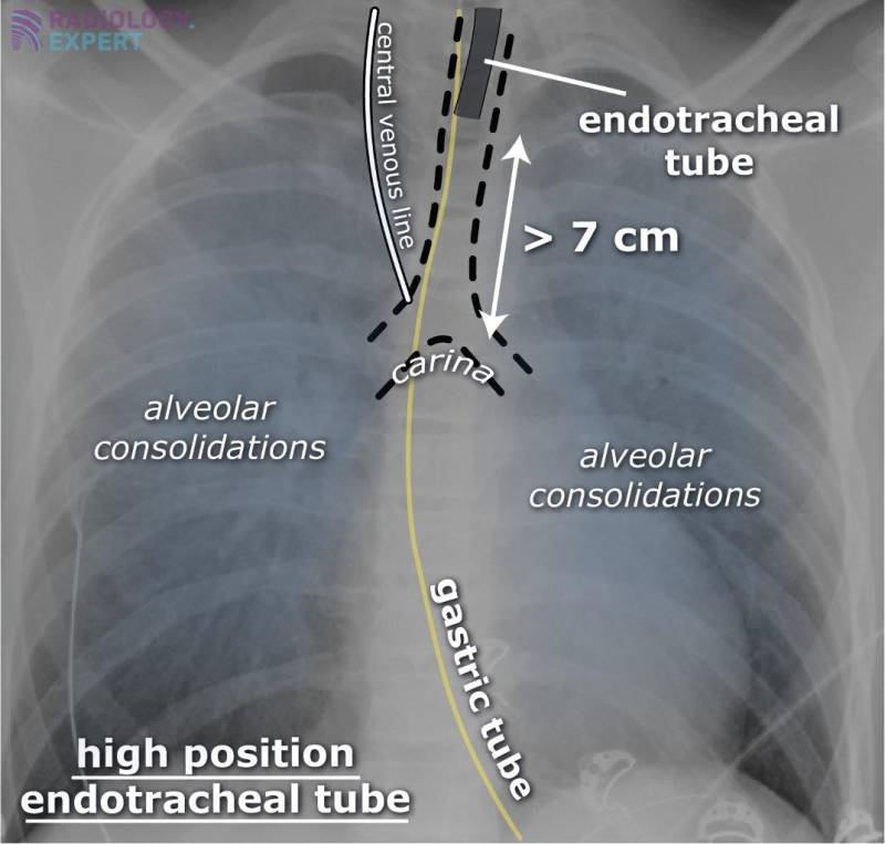 Chest X-ray ICU