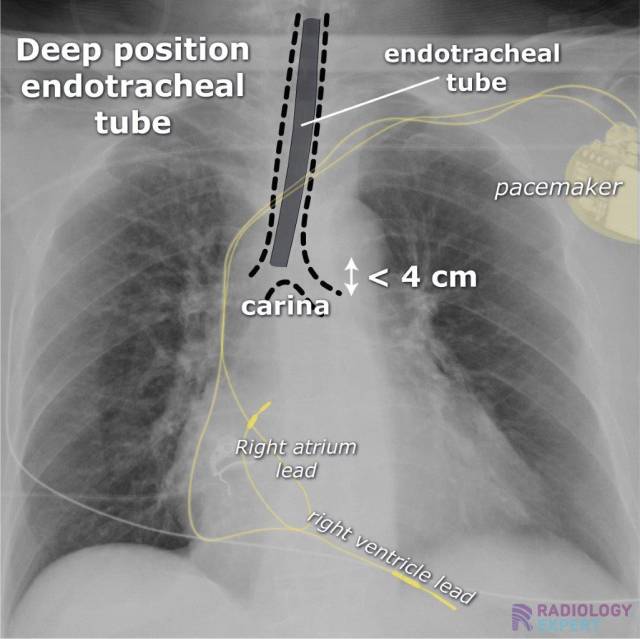 Chest X-ray ICU