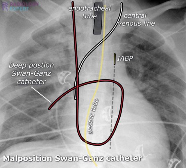 Chest X-ray ICU