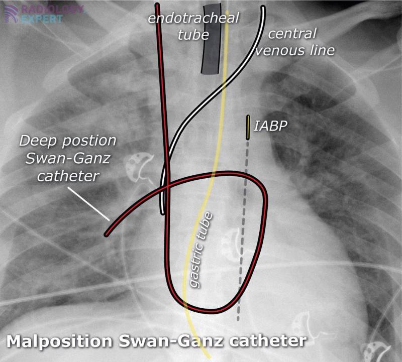 Chest X-ray ICU