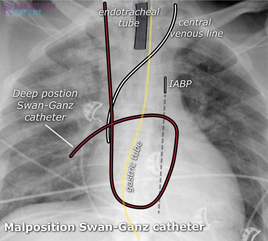Chest X-ray ICU