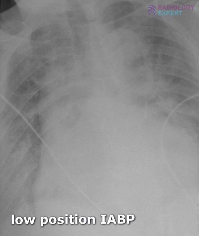 Chest X-ray ICU