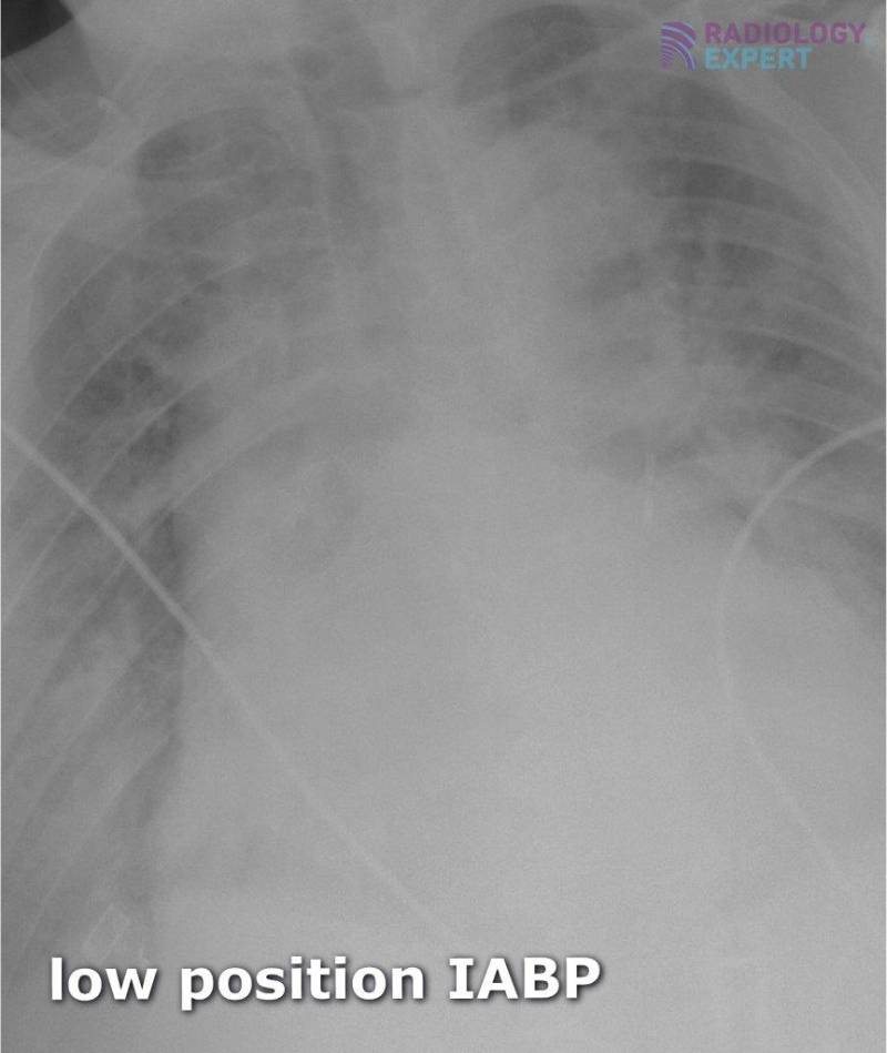 Chest X-ray ICU