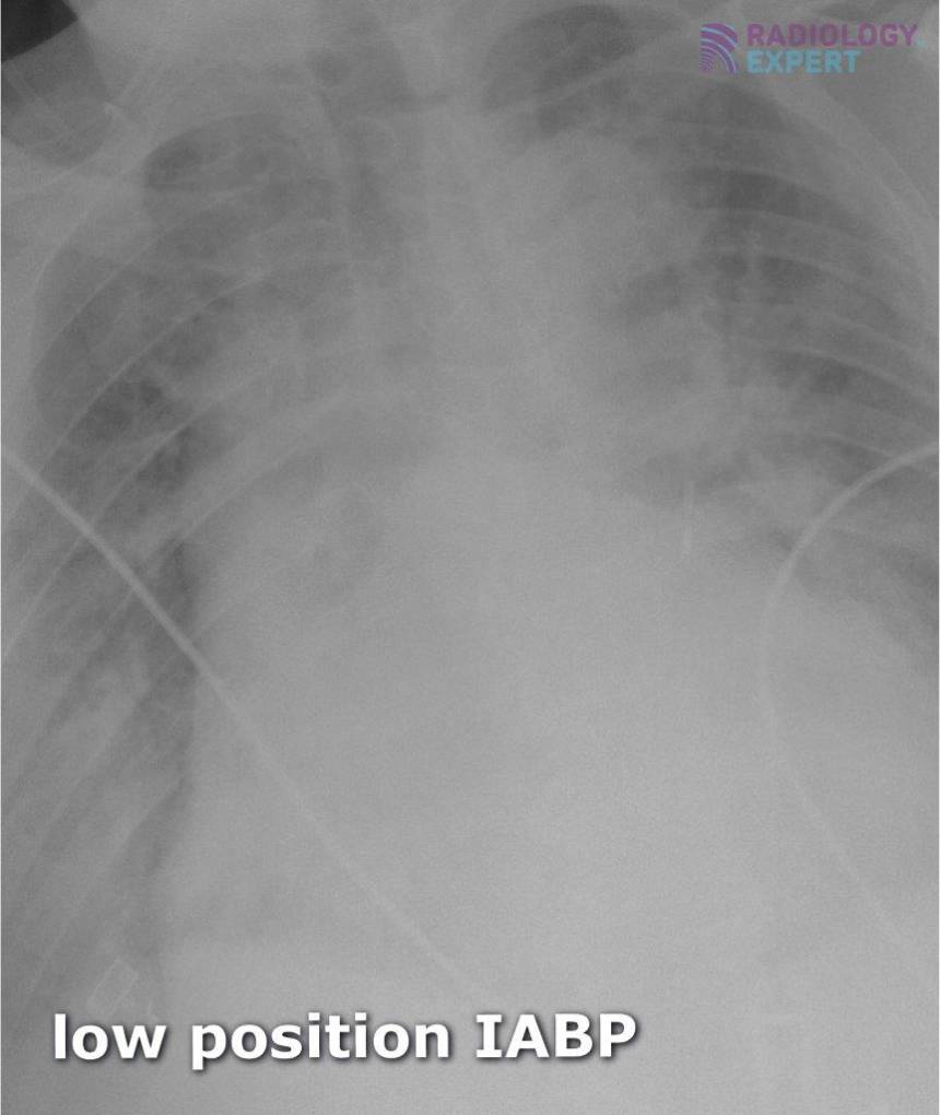 Chest X-ray ICU