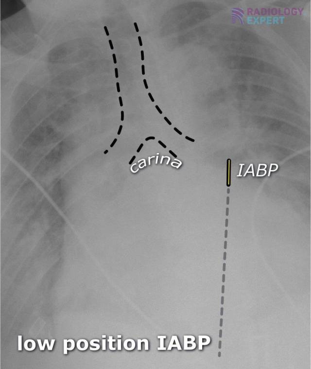 Chest X-ray ICU