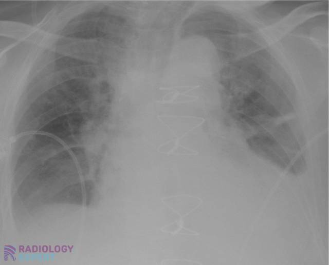 Chest X-ray ICU
