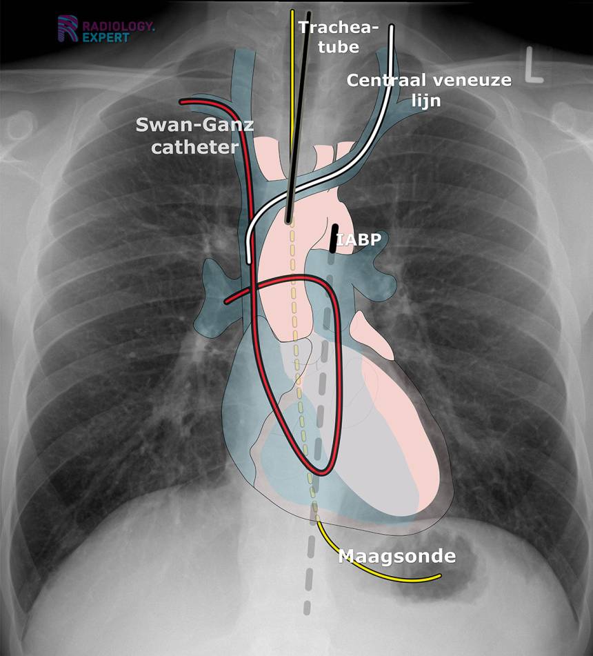 X-Thorax IC