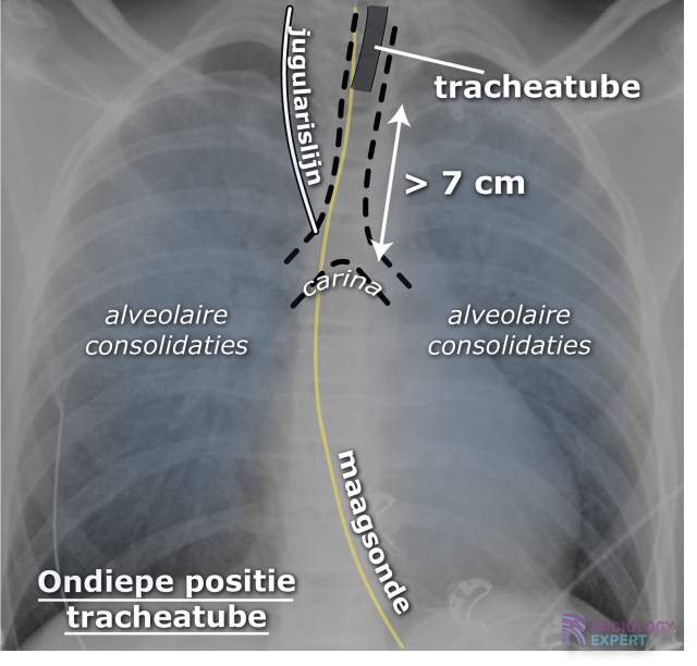 X-Thorax IC