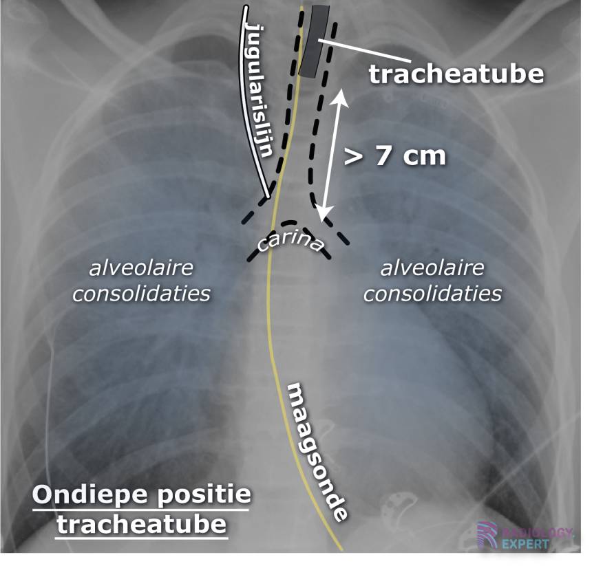 X-Thorax IC