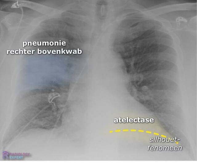 X-Thorax IC