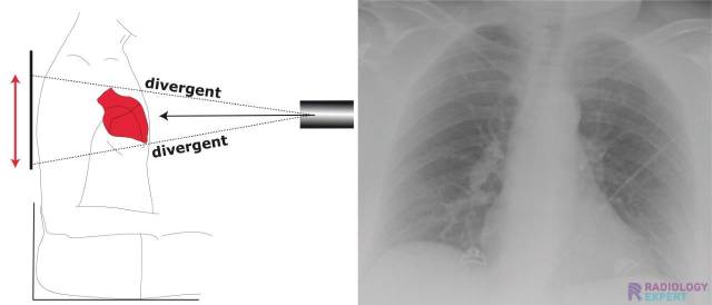 Chest X-ray