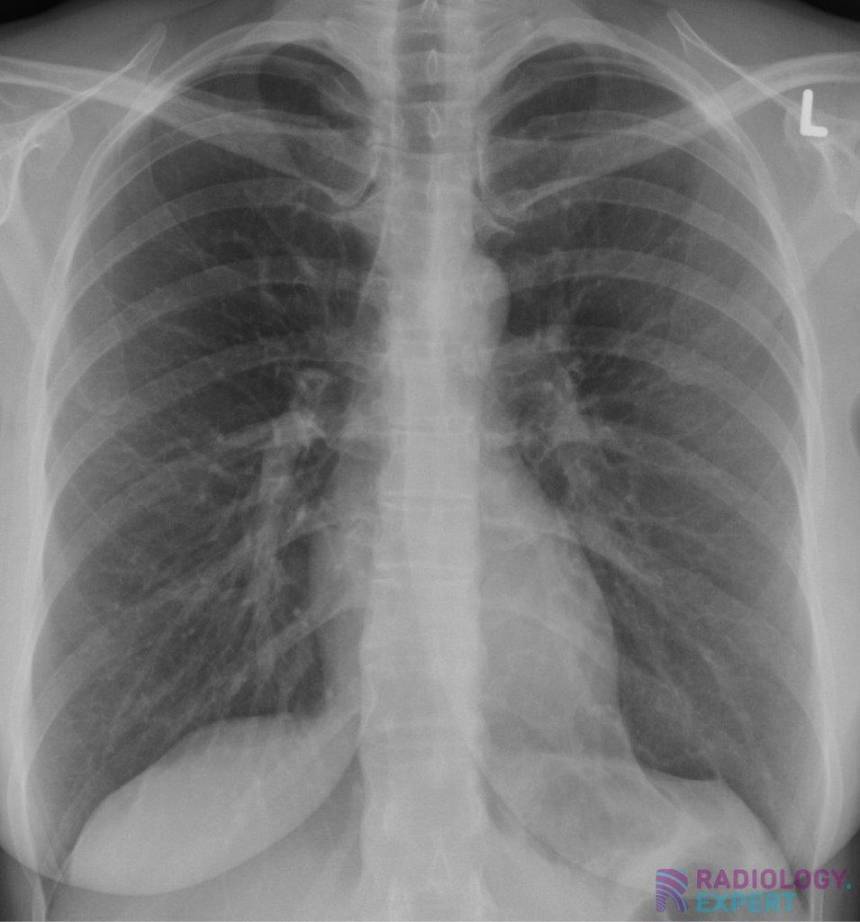 Chest X-ray