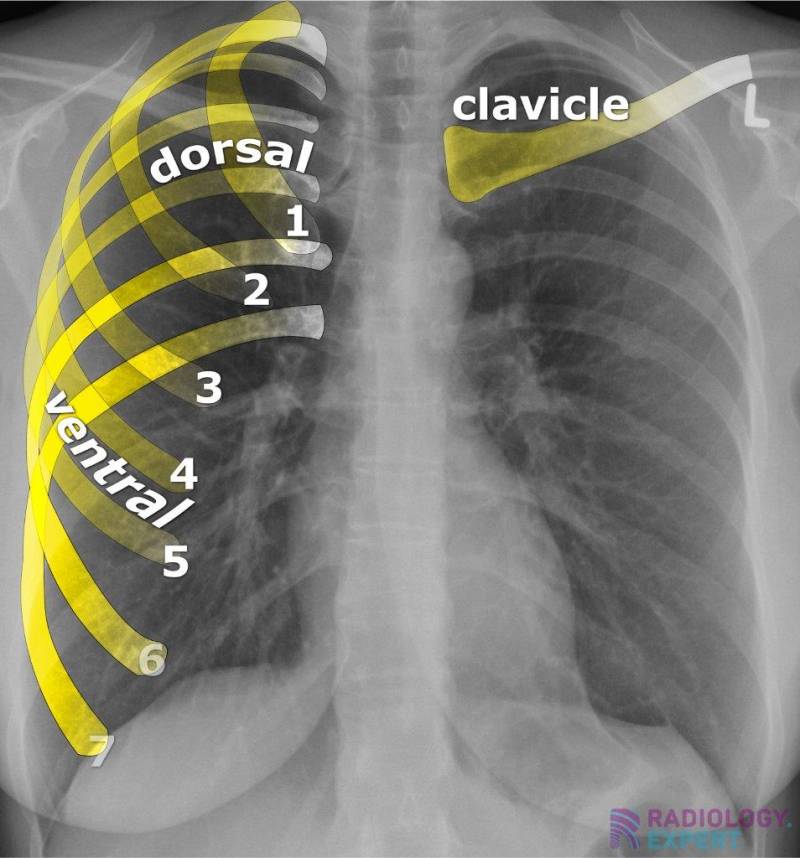 Chest X-ray