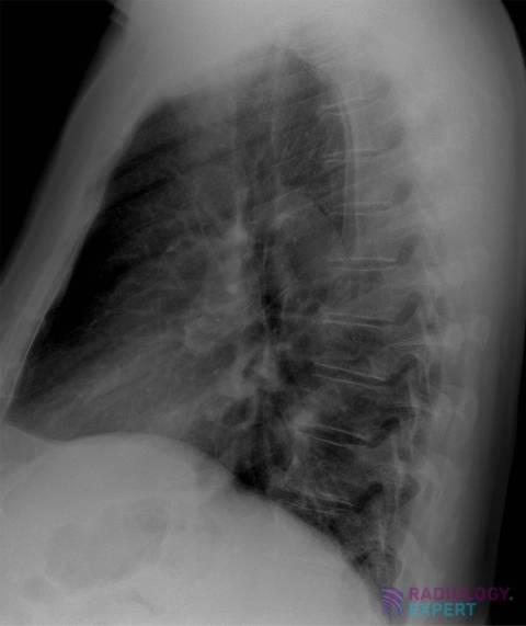 Chest X-ray