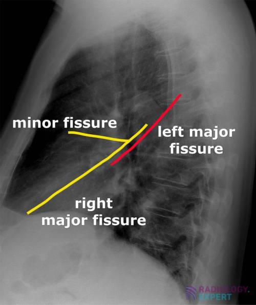 Chest X-ray