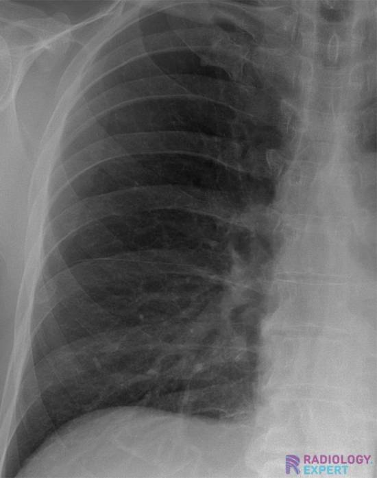 Chest X-ray