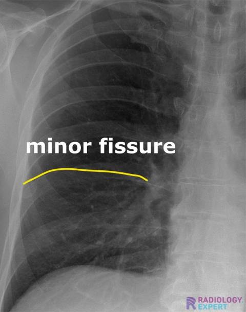 Chest X Ray