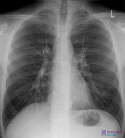 Normal Chest Xray