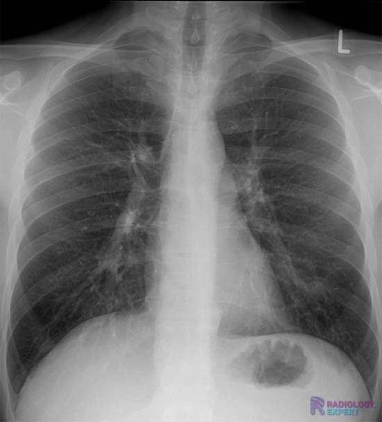 Chest X-ray