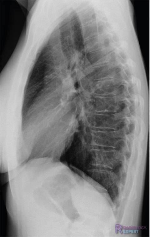 Left Lateral Chest X Ray Chest Radiograph