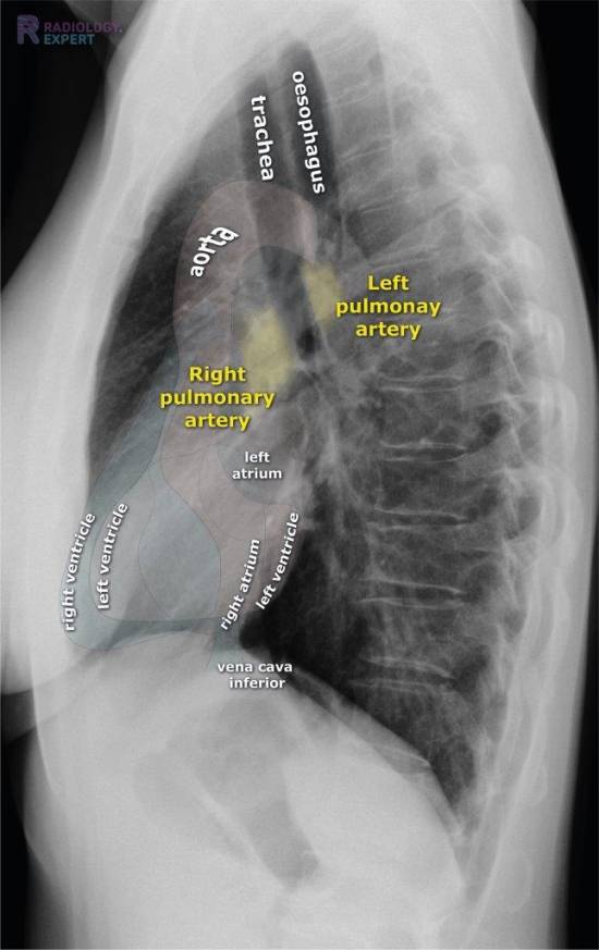 Lateral Chest X Ray Anatomy