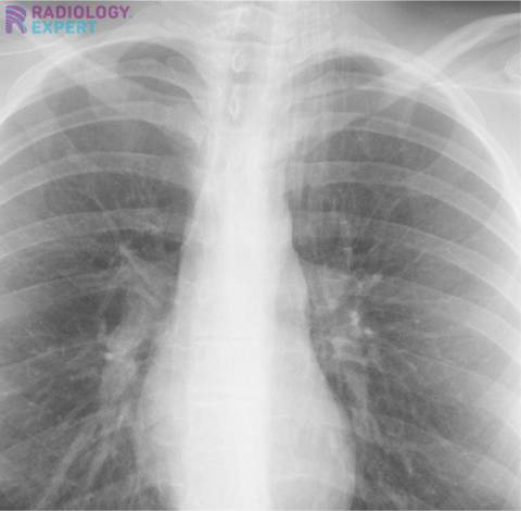 Chest X-ray