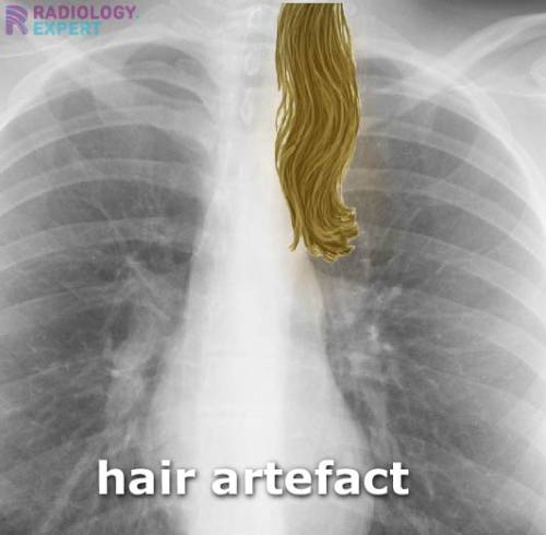 Chest X-ray