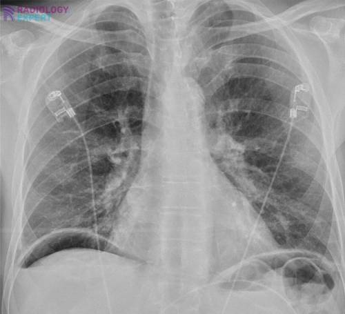 Chest X-ray