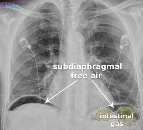 Chest X-ray