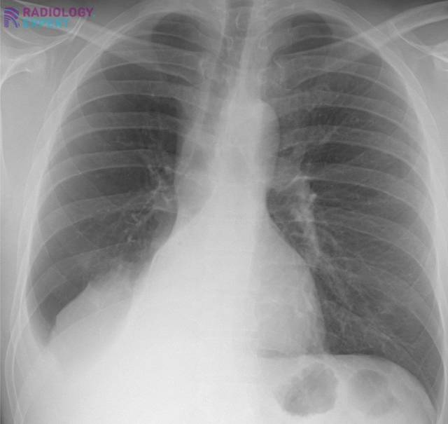 chest x ray pathologies