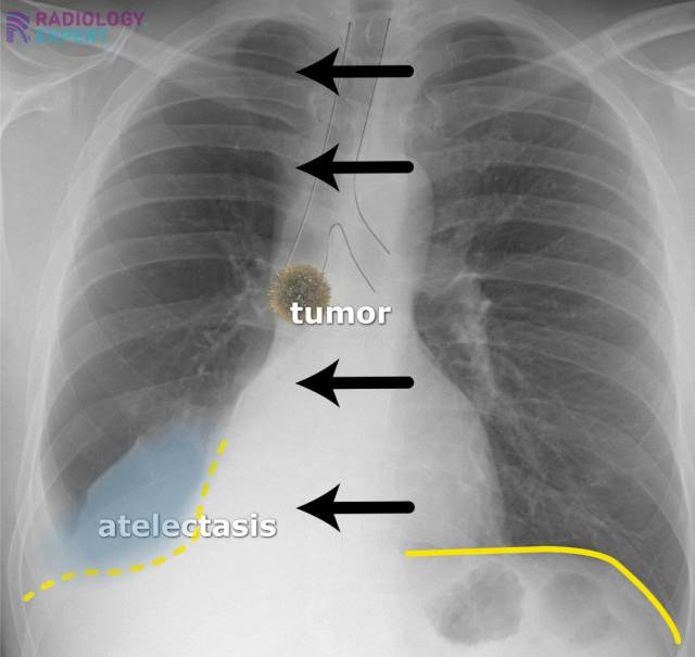 Chest X-ray