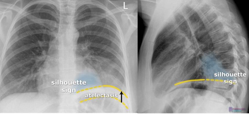 Chest X-ray