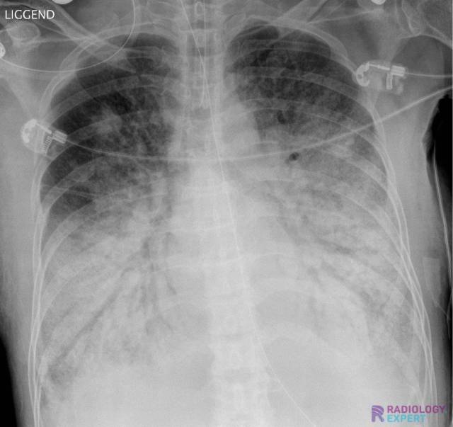Air Bronchograms On Cxr