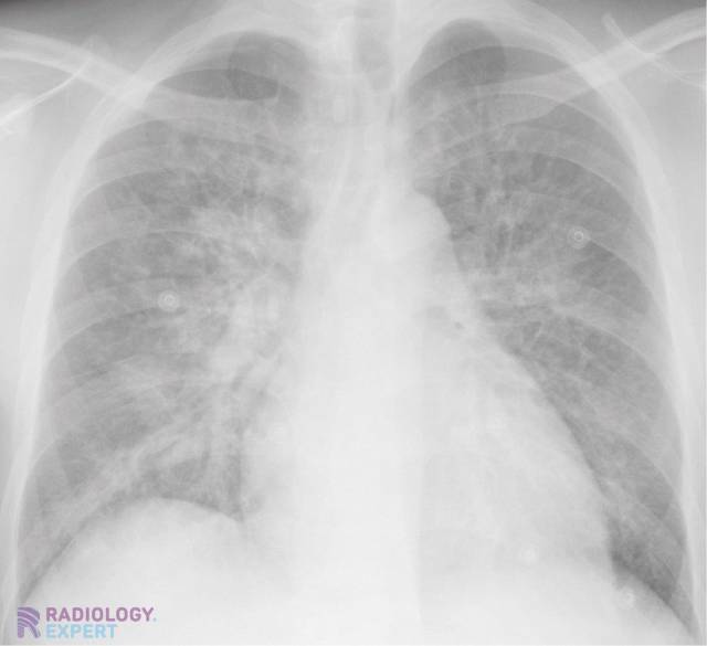 Chest X-ray
