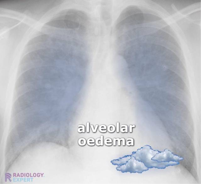 Chest X-ray