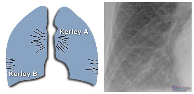 Chest X-ray