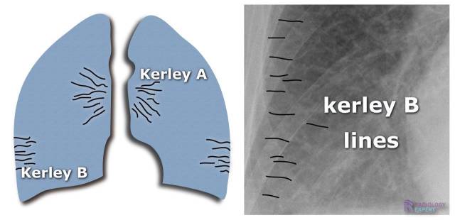 Chest X Ray