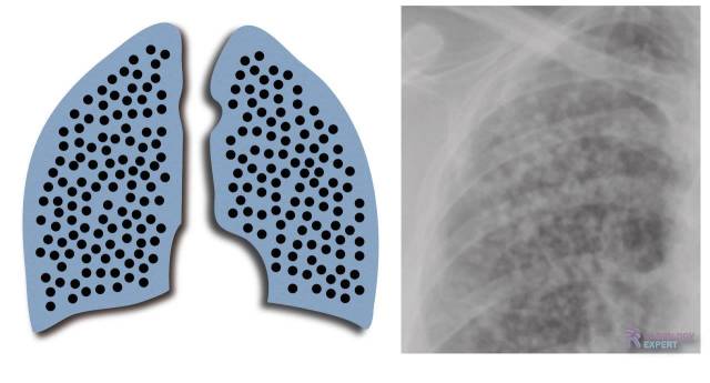 Chest X-ray