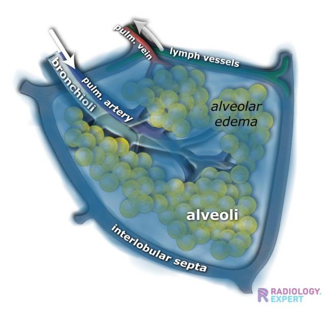 Chest X-ray
