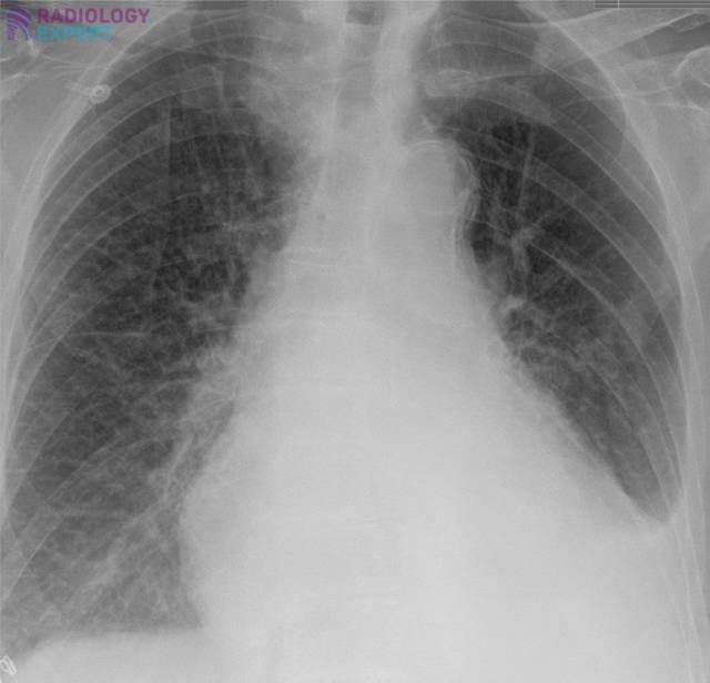Chest X Ray Bronchitis Vs Pneumonia