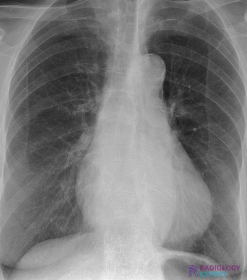 Chest X-ray