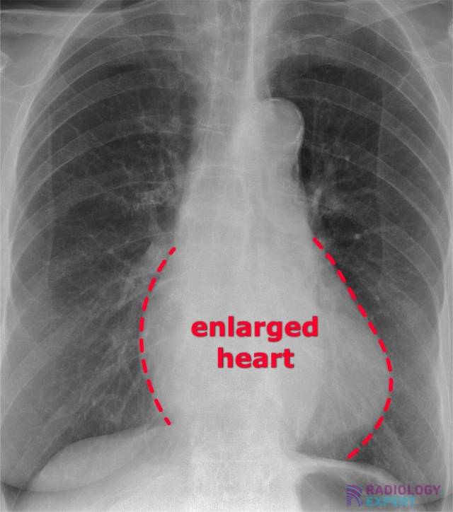 Chest X-ray