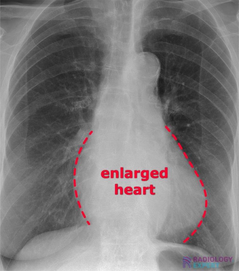 Chest X-ray